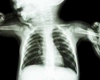 Puskesmas Cipayung Gelar Rontgen TBC untuk Anak | AtmaGo